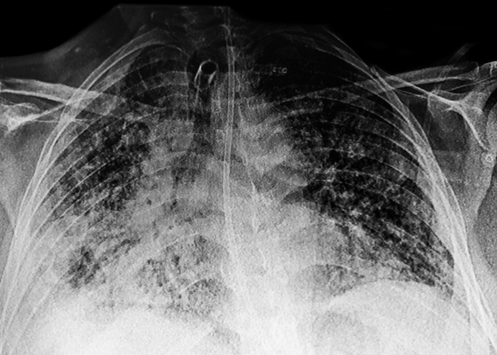 A Primer On Legionnaires Disease A Primer On Legionnaires Disease